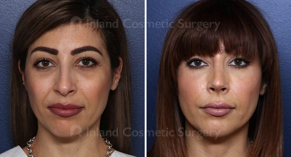 Rhinoplasty and Fat Transfer - Inland Cosmetic Surgery