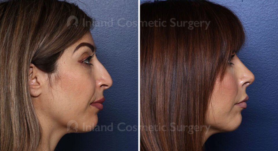 Rhinoplasty and Fat Transfer - Inland Cosmetic Surgery