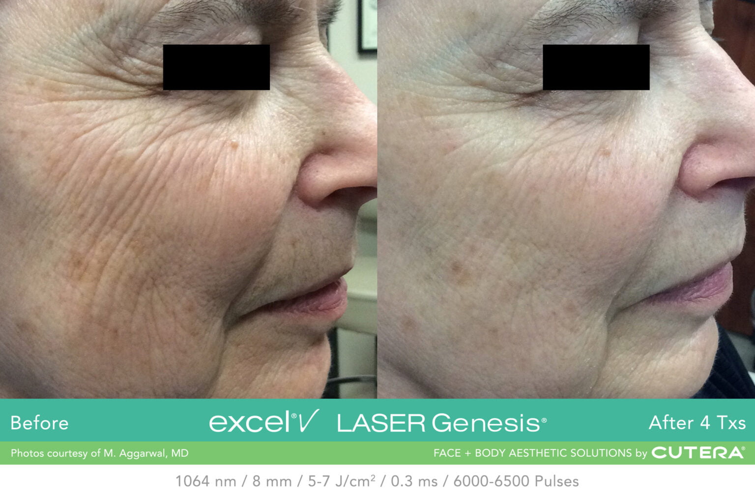 Cutera Laser Genesis | Inland Cosmetic Surgery, Ahava MedSpa, & Made ...