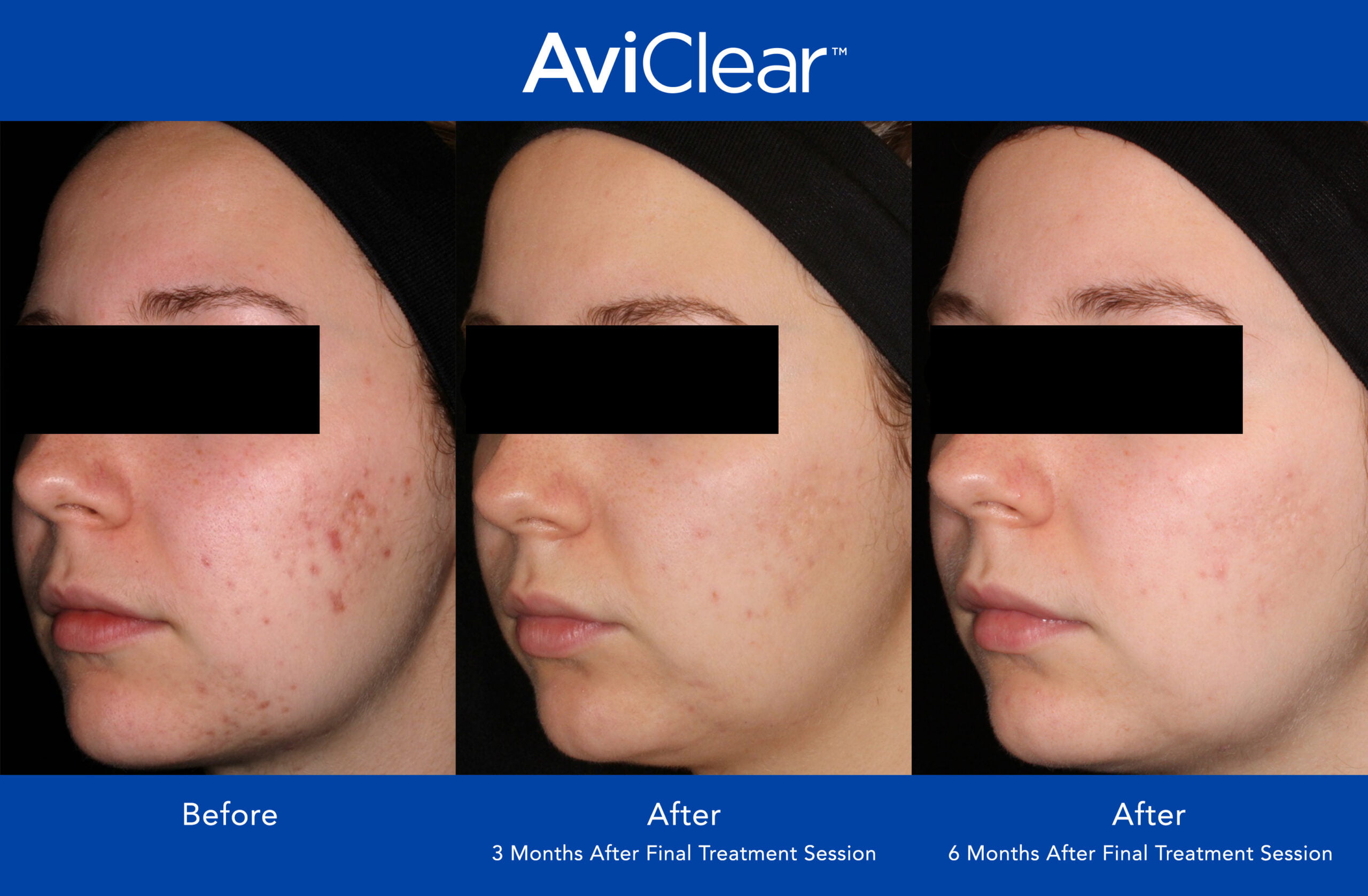 AviClear Rancho Cucamonga | Acne Laser Treatment | Ahava Medspa