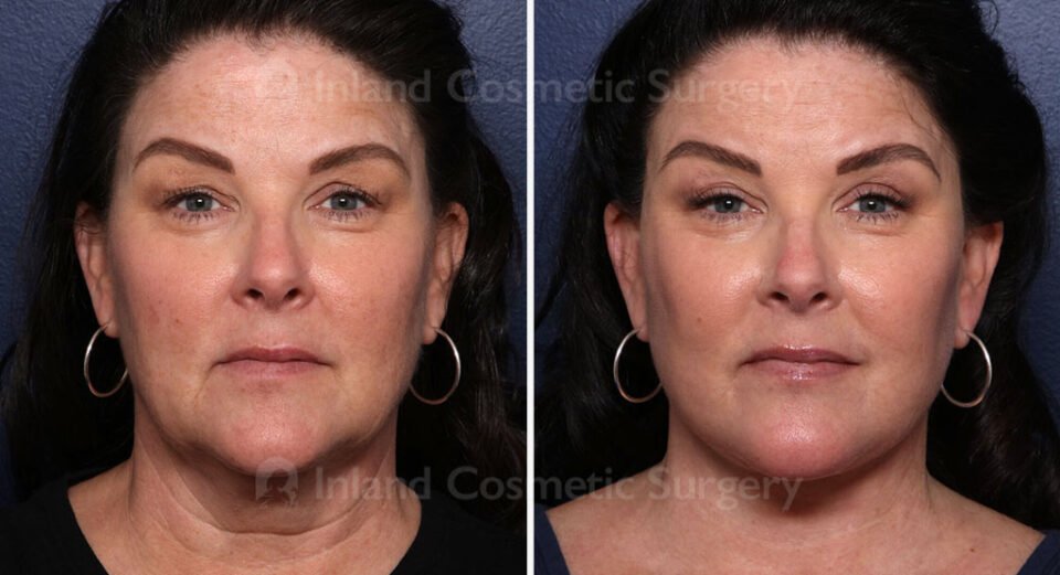 Face Lift, Neck Lift, Fat Grafting, & Eyelid Lift - Inland Cosmetic Surgery