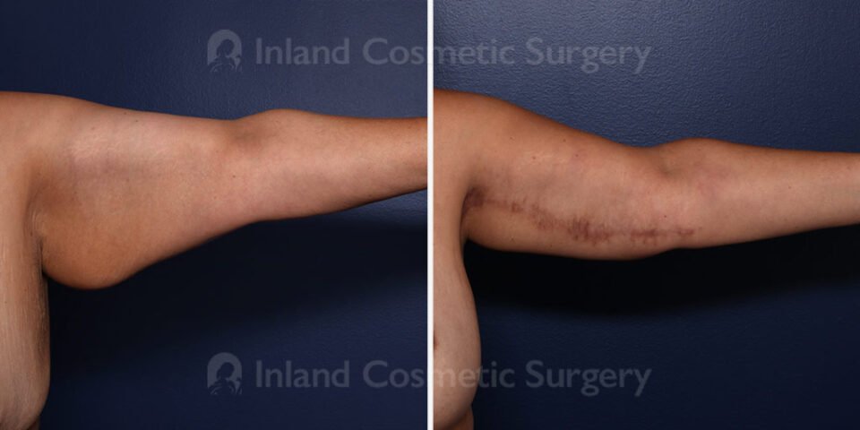 Upper Arm Lift - Inland Cosmetic Surgery