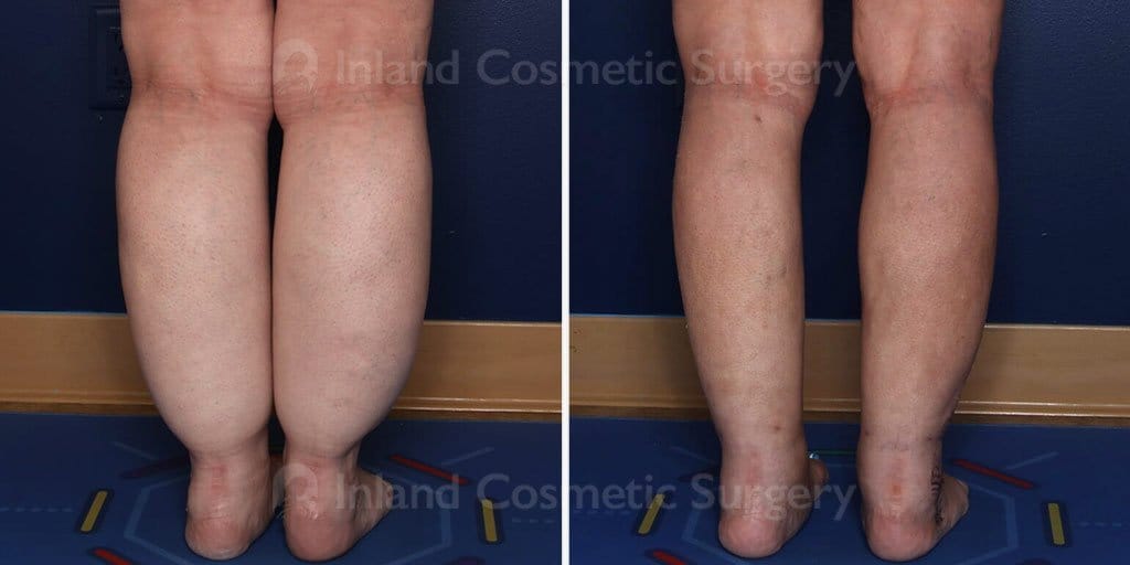 Liposuction - Inland Cosmetic Surgery